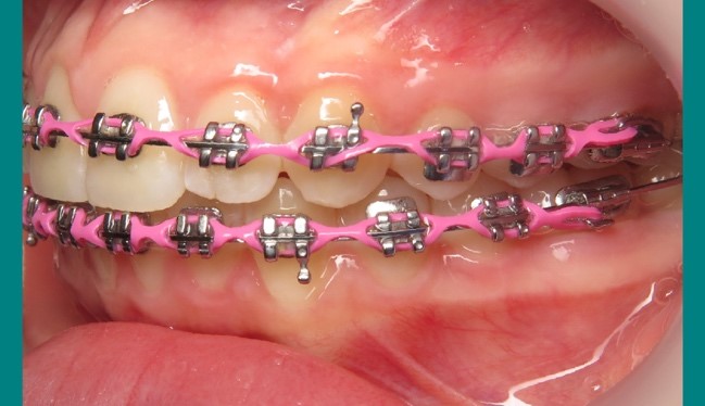 Conventional fixed braces Dr Erfan Salloum Specialist Orthodontist in Dublin
