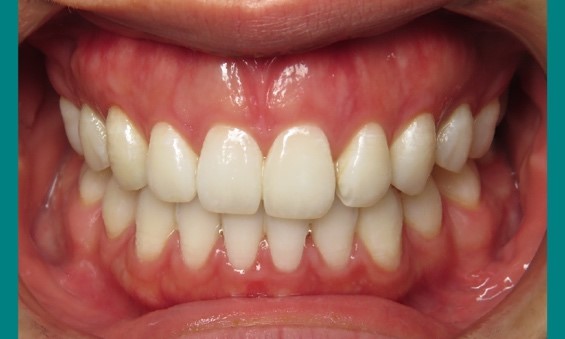 Lingual Fixed Braces - Dr Erfan Salloum | Specialist Orthodontist in Dublin