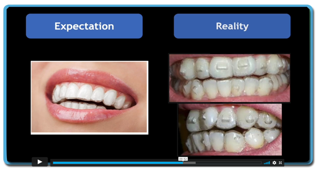 Clear Aligners Dr Erfan Salloum Specialist Orthodontist In Dublin