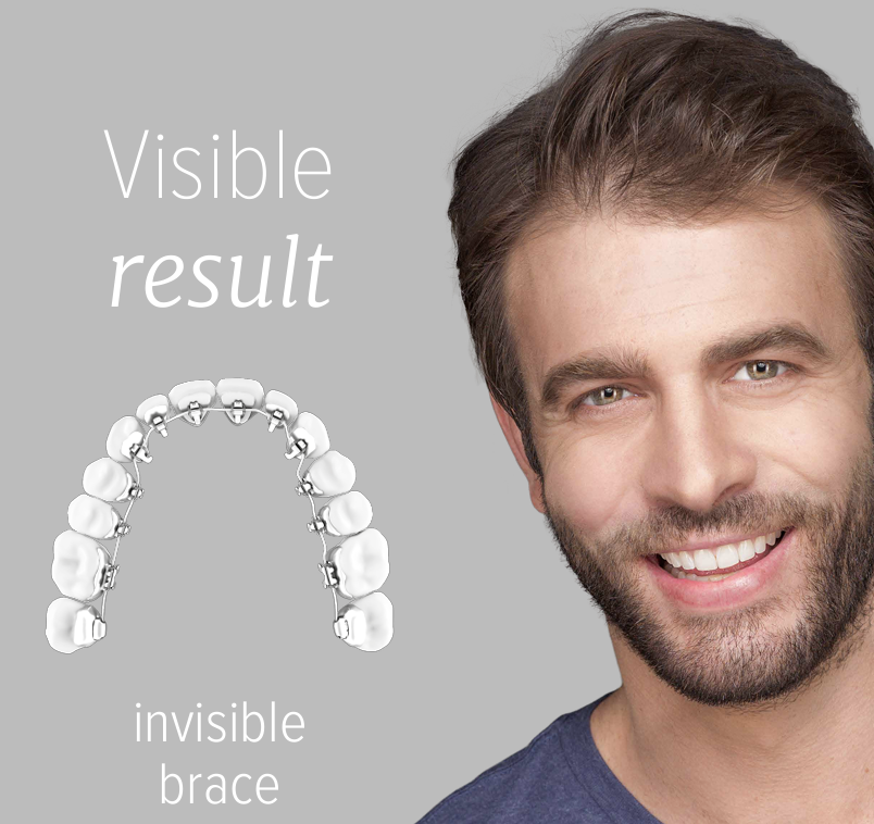 Lingual Braces: Next Generation Orthodontic Care - Dr Erfan Salloum ...