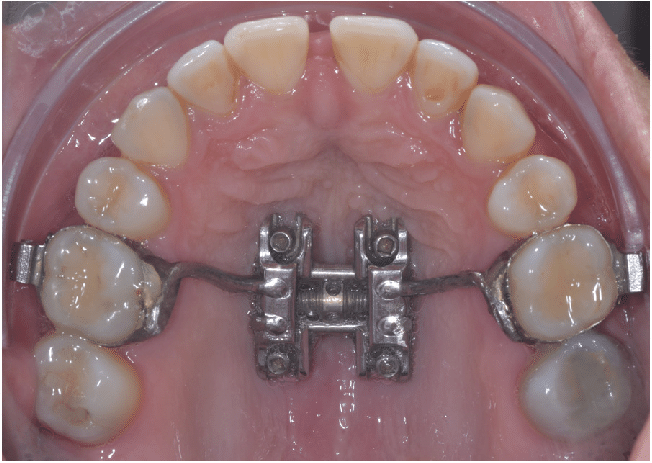MARPE Dublin: The New Trend in Orthodontics - Dr Erfan Salloum ...