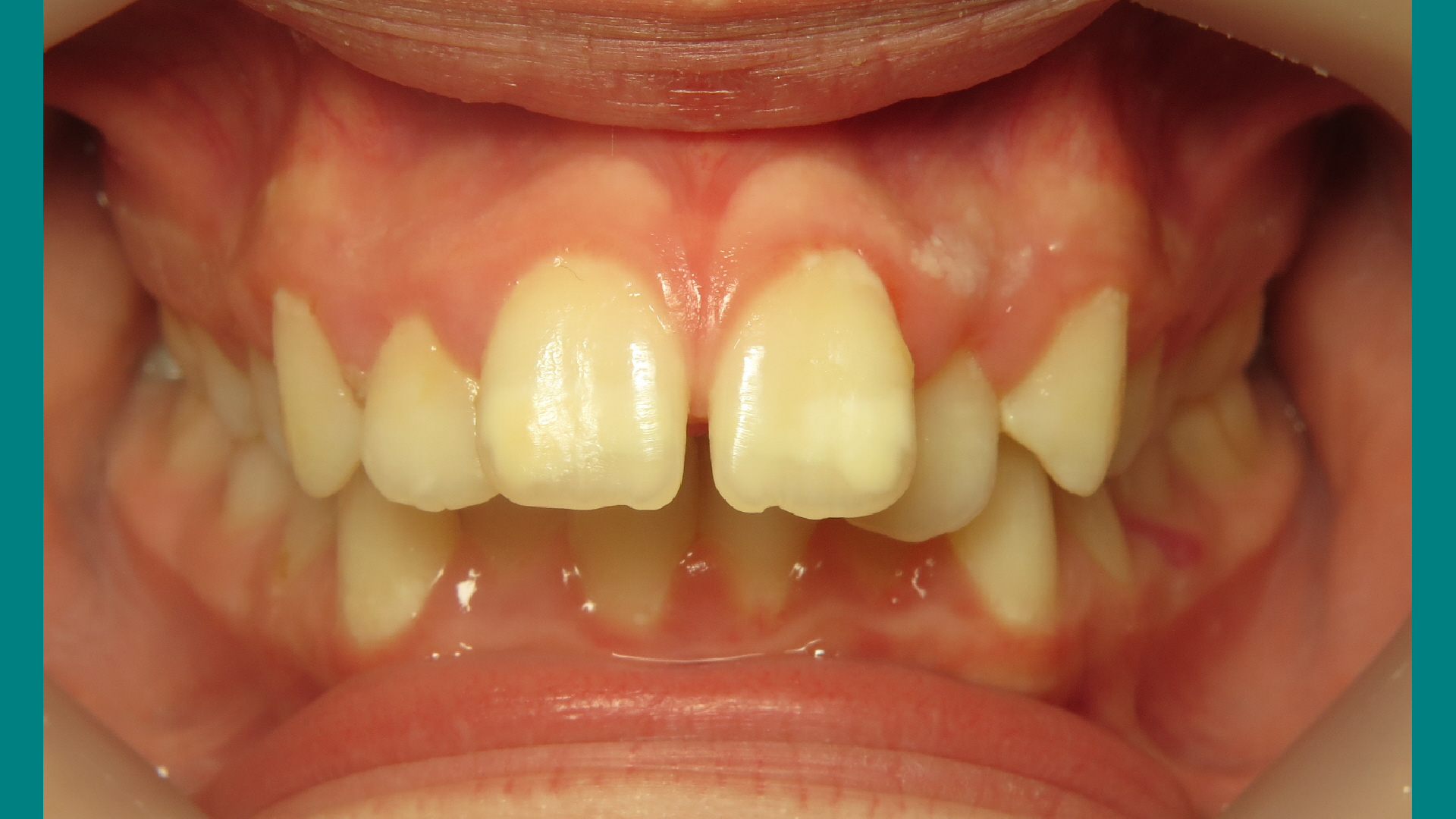 Orthodontic Options to Treat Protruded Teeth (Increased Overjet) - Dr ...